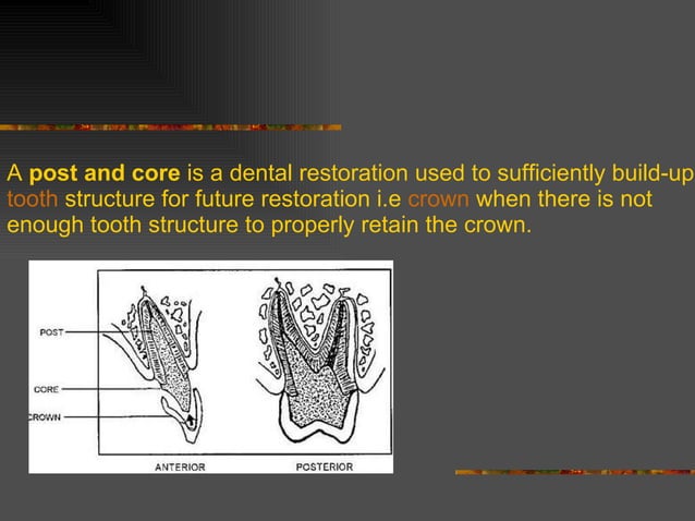 Post and core | PPT | Oral care | Personal Care