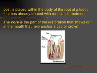 Post and core | PPT