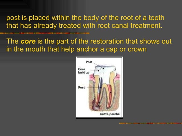 Post and core | PPT | Oral care | Personal Care