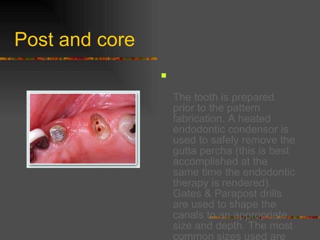 Post and core | PPT | Oral care | Personal Care