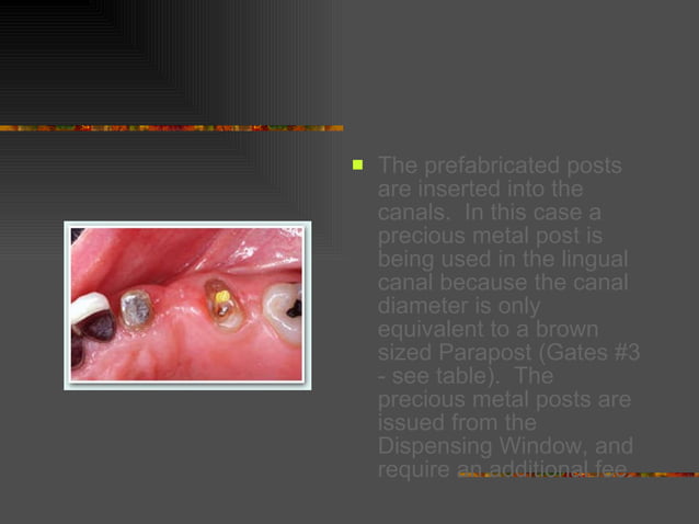 Post and core | PPT | Oral care | Personal Care