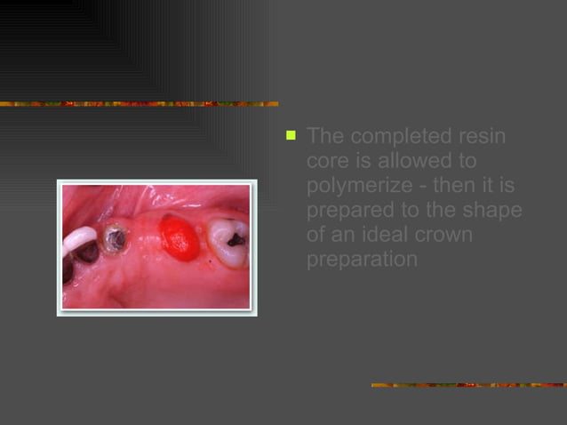 Post and core | PPT | Oral care | Personal Care