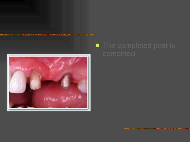 Post and core | PPT | Oral care | Personal Care