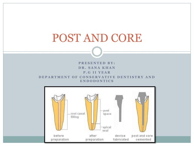 Post and core | PPTX