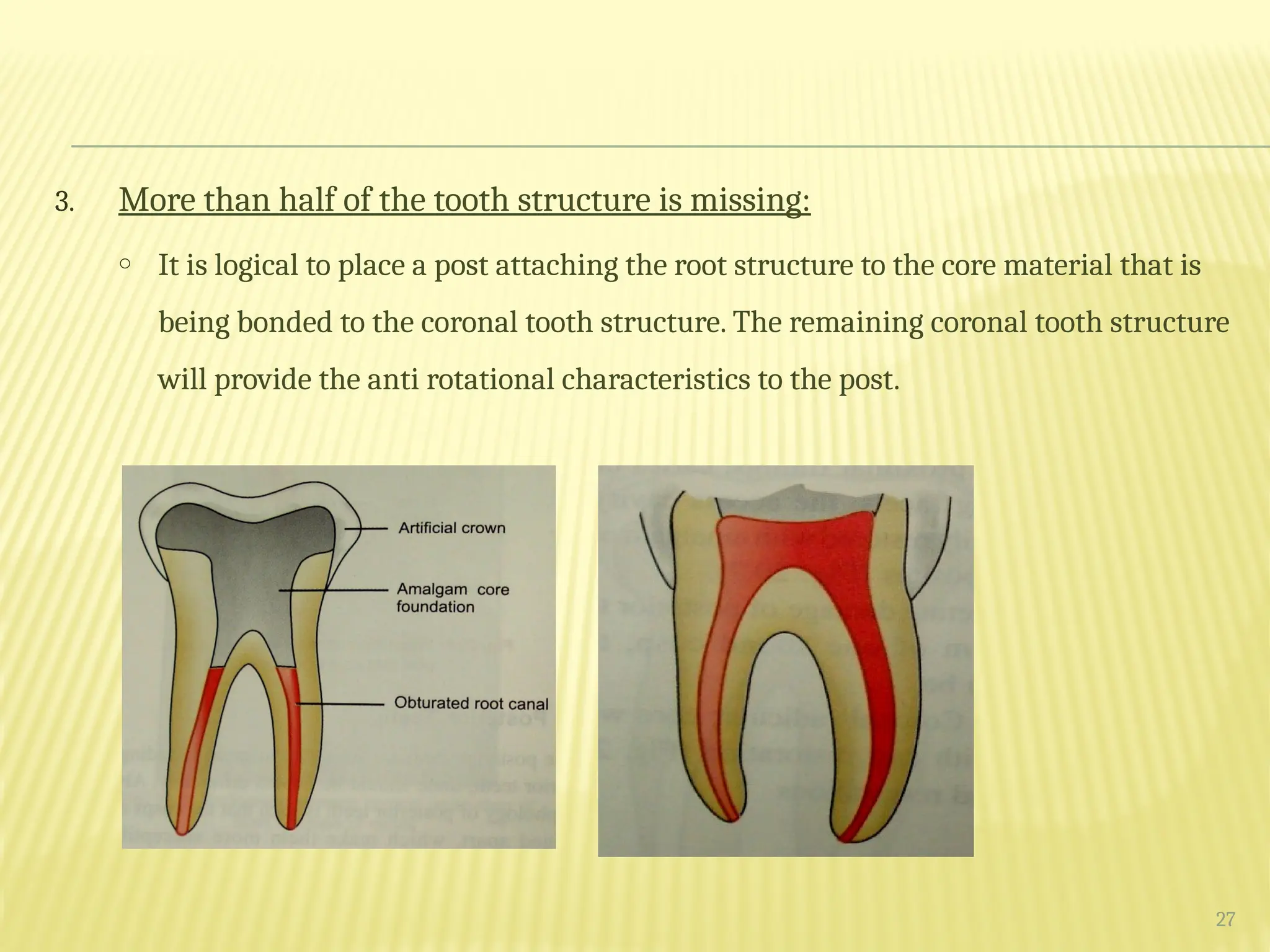 post and core implications in prosthodontics | PPTX