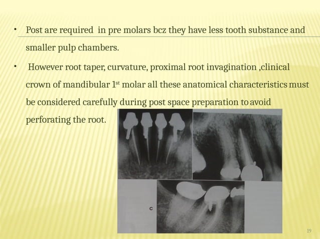 post and core implications in prosthodontics | PPTX | Dental Health ...