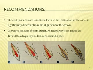 post and core implications in prosthodontics | PPTX