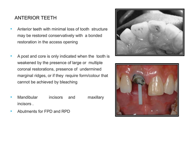 Post and core | PPTX | Dental Health | Diseases and Conditions