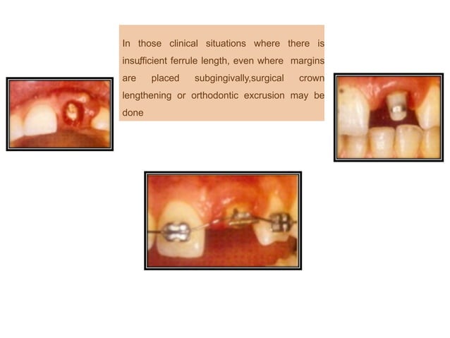 Post and core | PPTX | Dental Health | Diseases and Conditions