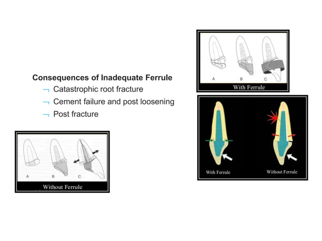Post and core | PPTX | Dental Health | Diseases and Conditions