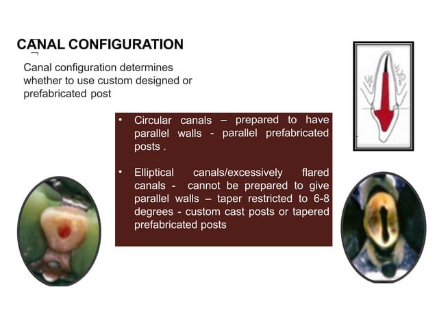 Post and core | PPTX | Dental Health | Diseases and Conditions