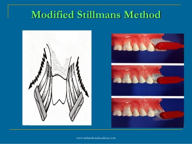 Post cementation/prosthodontic courses