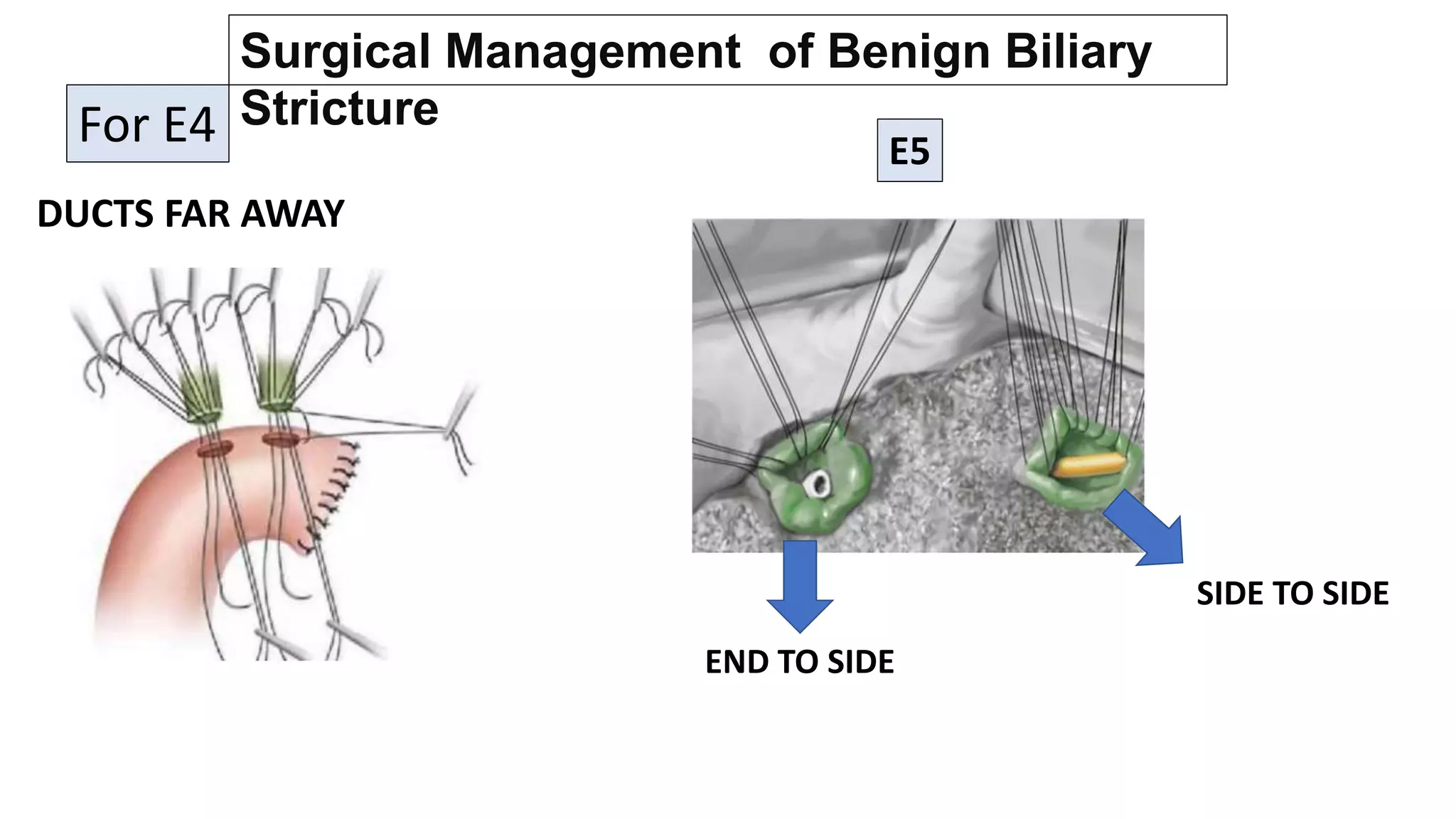 Bile duct injury.pptx