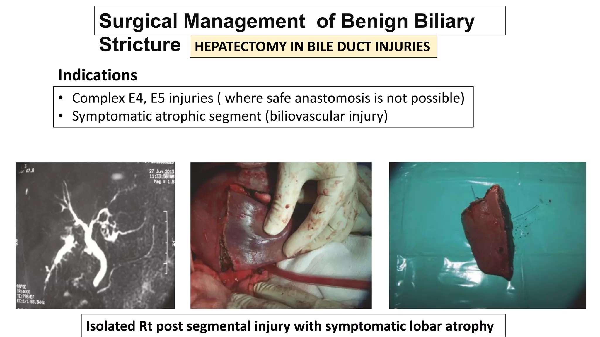 Bile duct injury.pptx