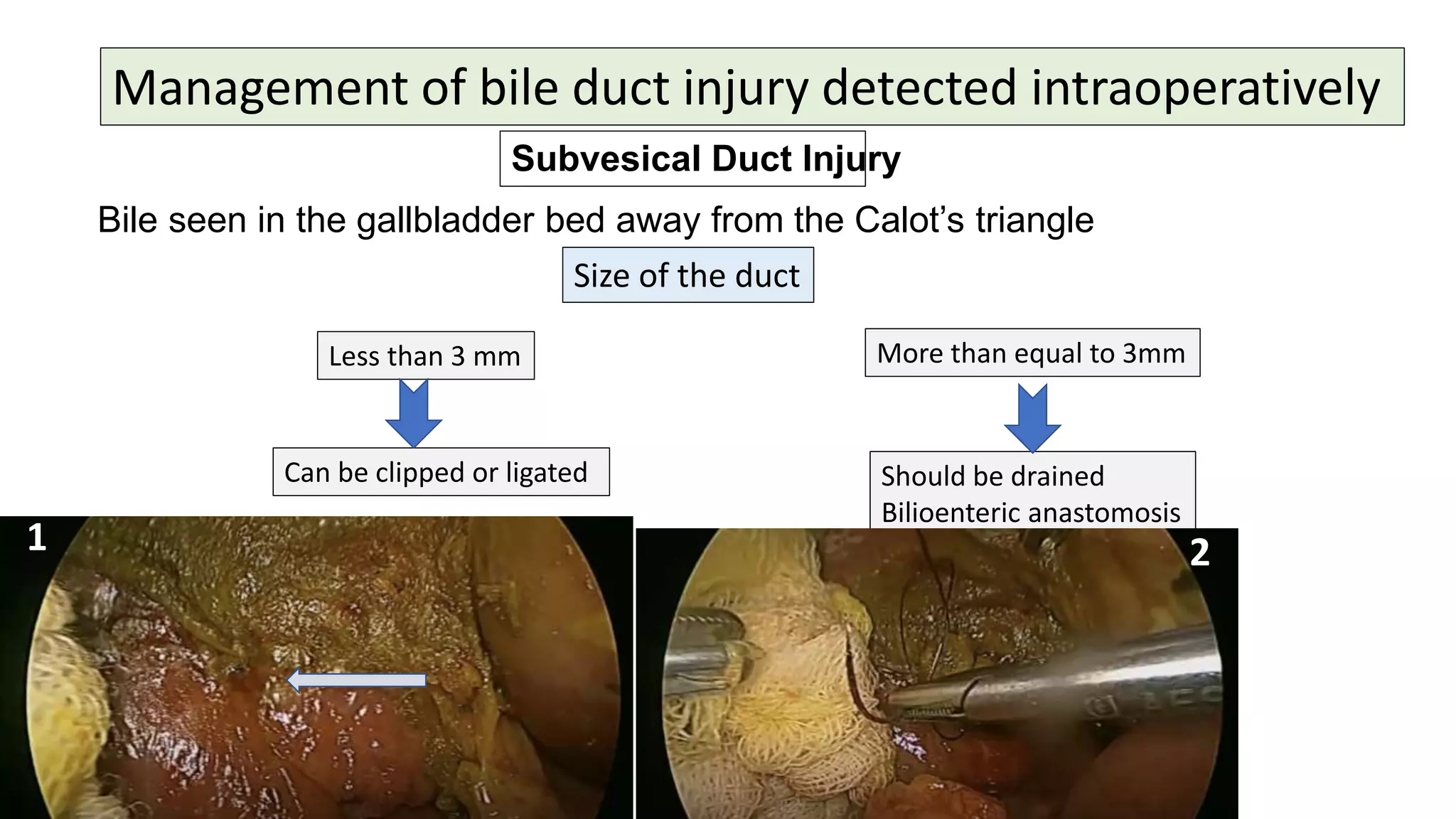 Bile duct injury.pptx