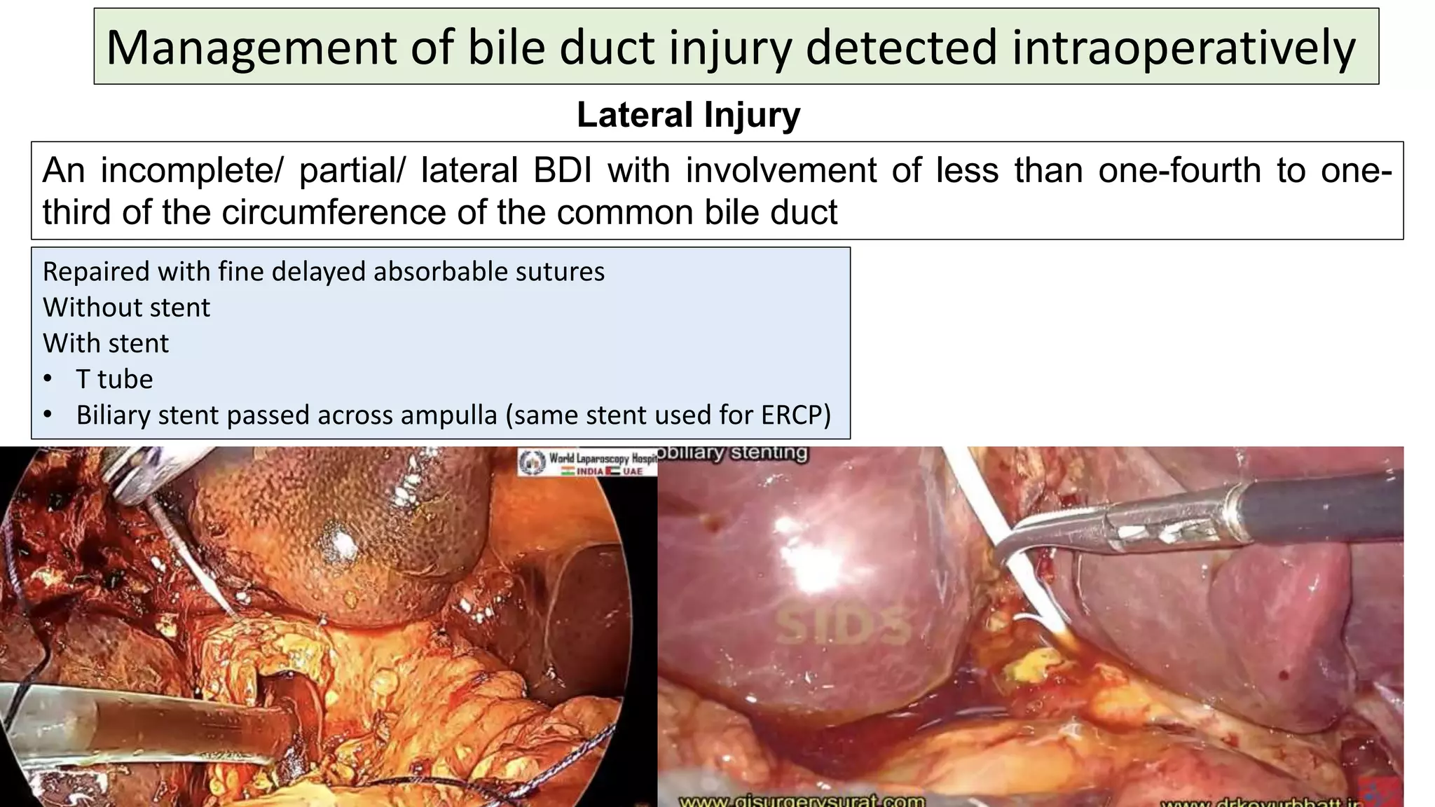 Bile duct injury.pptx