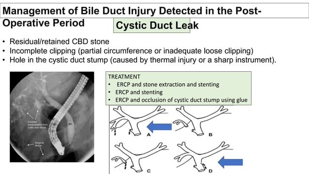 Bile duct injury.pptx