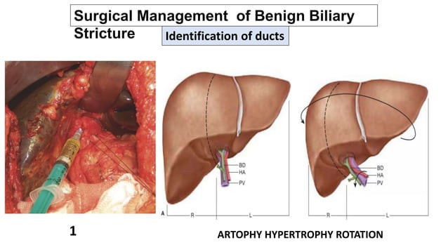 Bile duct injury.pptx