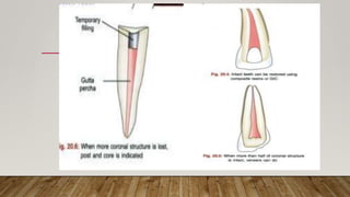 POST&CORE.ppt | Dental Health | Diseases and Conditions