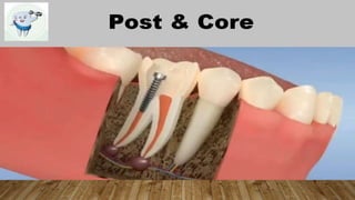 POST&CORE.ppt | Dental Health | Diseases and Conditions