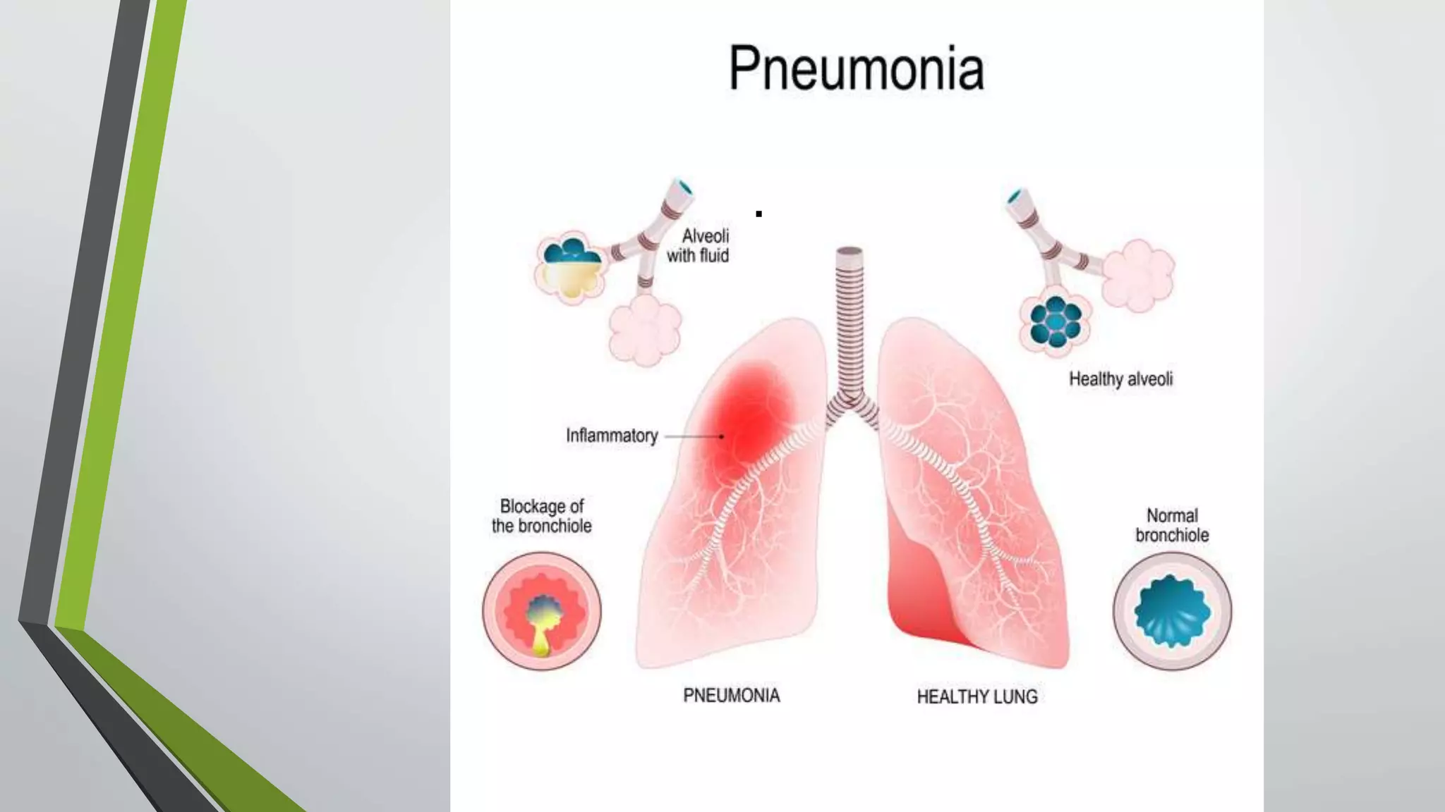 Post covid pneumonia ppt slideshare | PPTX