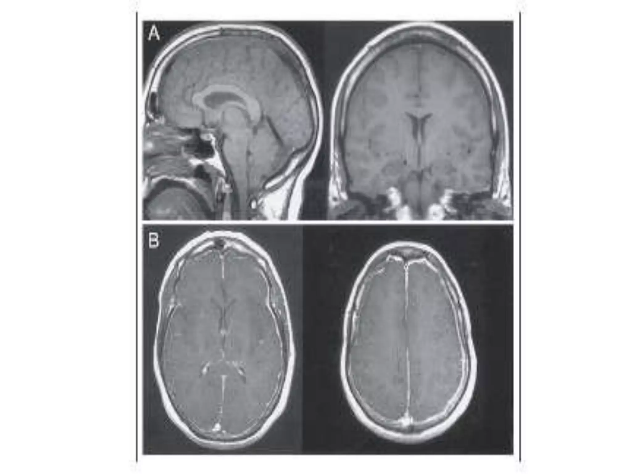 Post Dural Puncture Headache | PPTX