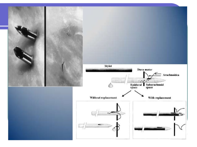 Post dural puncture headache | PPT Post dural puncture headache | PPT