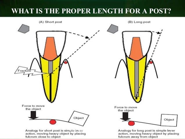 Post endodontic restoration/ orthodontic continuing education