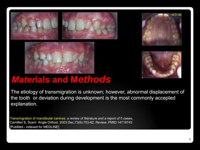 Transmigration of permanent mandibular canines | PDF | Dental Health ...