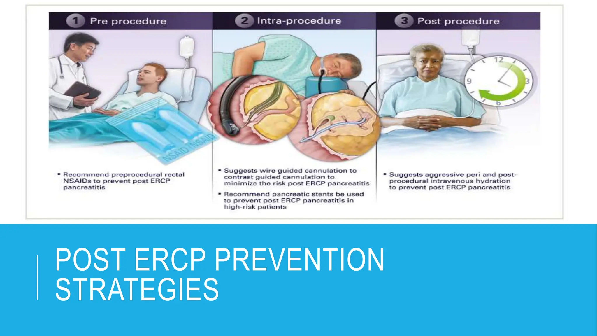 POST ERCP PANCREATITIS- RISK FACTORS / PREVENTION / TREATMENT | PPTX