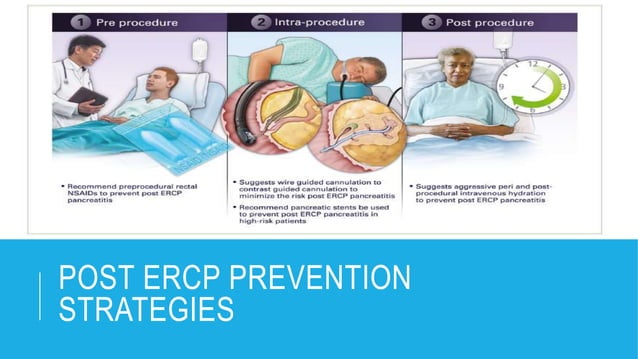 POST ERCP PANCREATITIS- RISK FACTORS / PREVENTION / TREATMENT | PPTX
