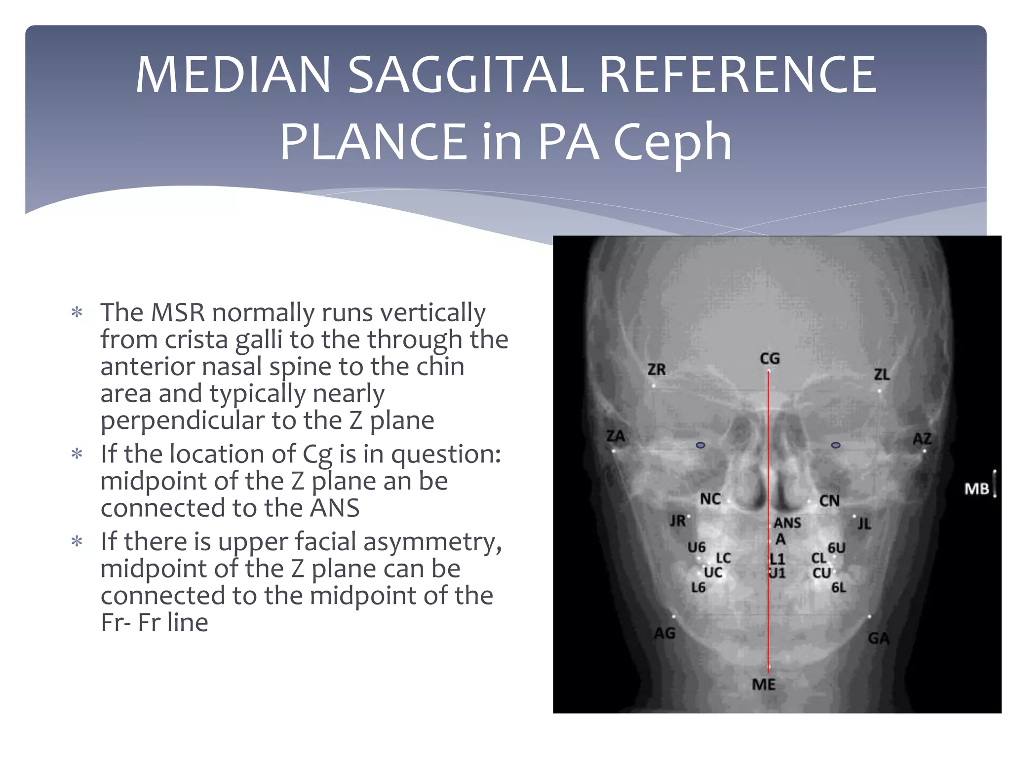Posterio anterior cephalometric analysis | PPTX