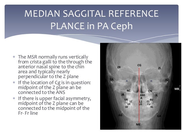 Posterio anterior cephalometric analysis