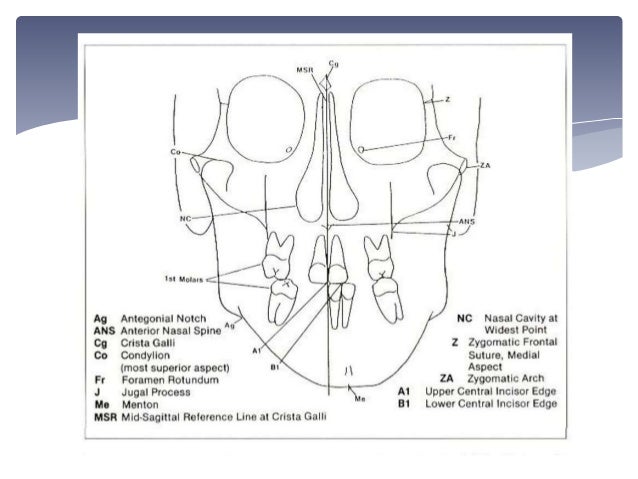 Posterio anterior cephalometric analysis