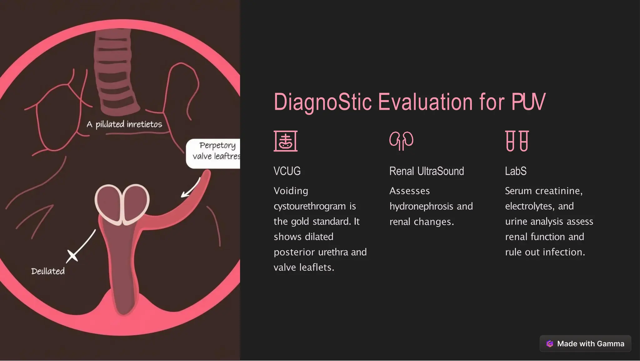 Posterior-Urethral-Valves-PUV-An-Overview (2).pptx