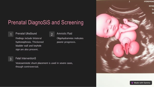 Posterior-Urethral-Valves-PUV-An-Overview (2).pptx