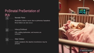 Posterior-Urethral-Valves-PUV-An-Overview (2).pptx