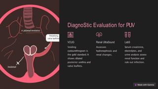 Posterior-Urethral-Valves-PUV-An-Overview (2).pptx