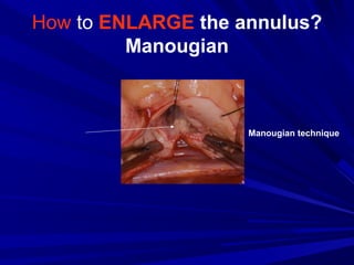 Posterior approach aortic root enlargement in redo aortic | PPT
