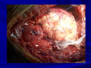 Posterior approach aortic root enlargement in redo aortic | PPT