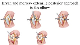 Posterior approach to elbow | PPT