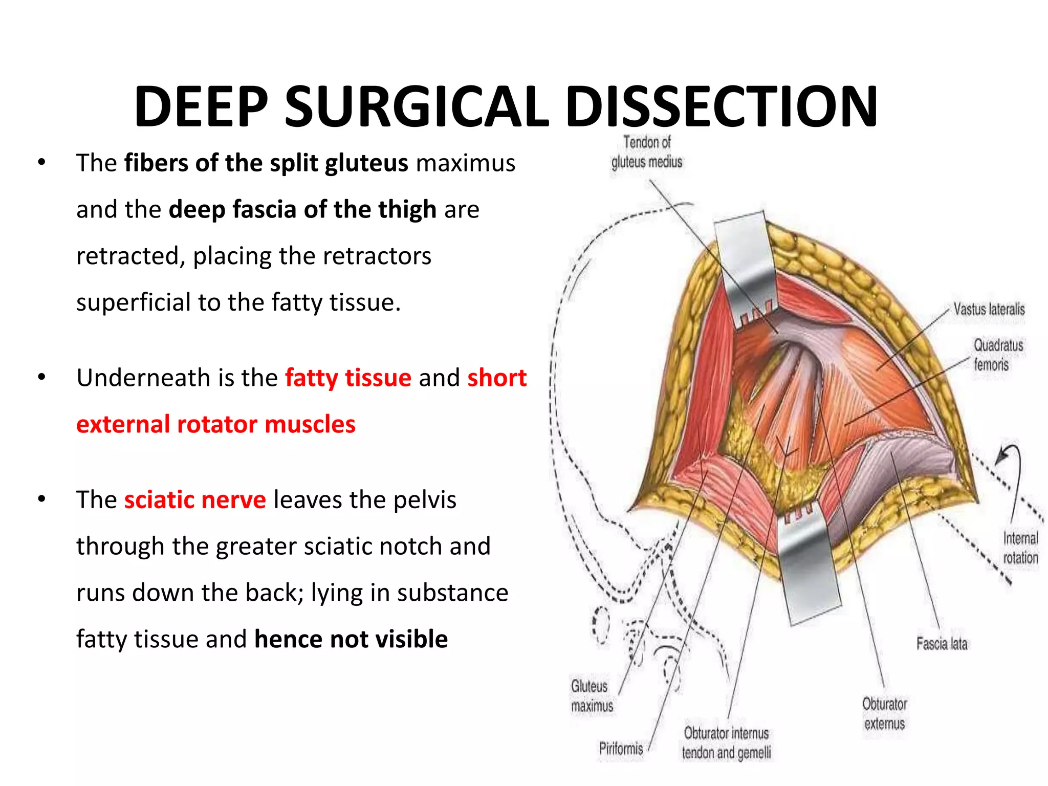 Posterior approach to the hip | PPTX
