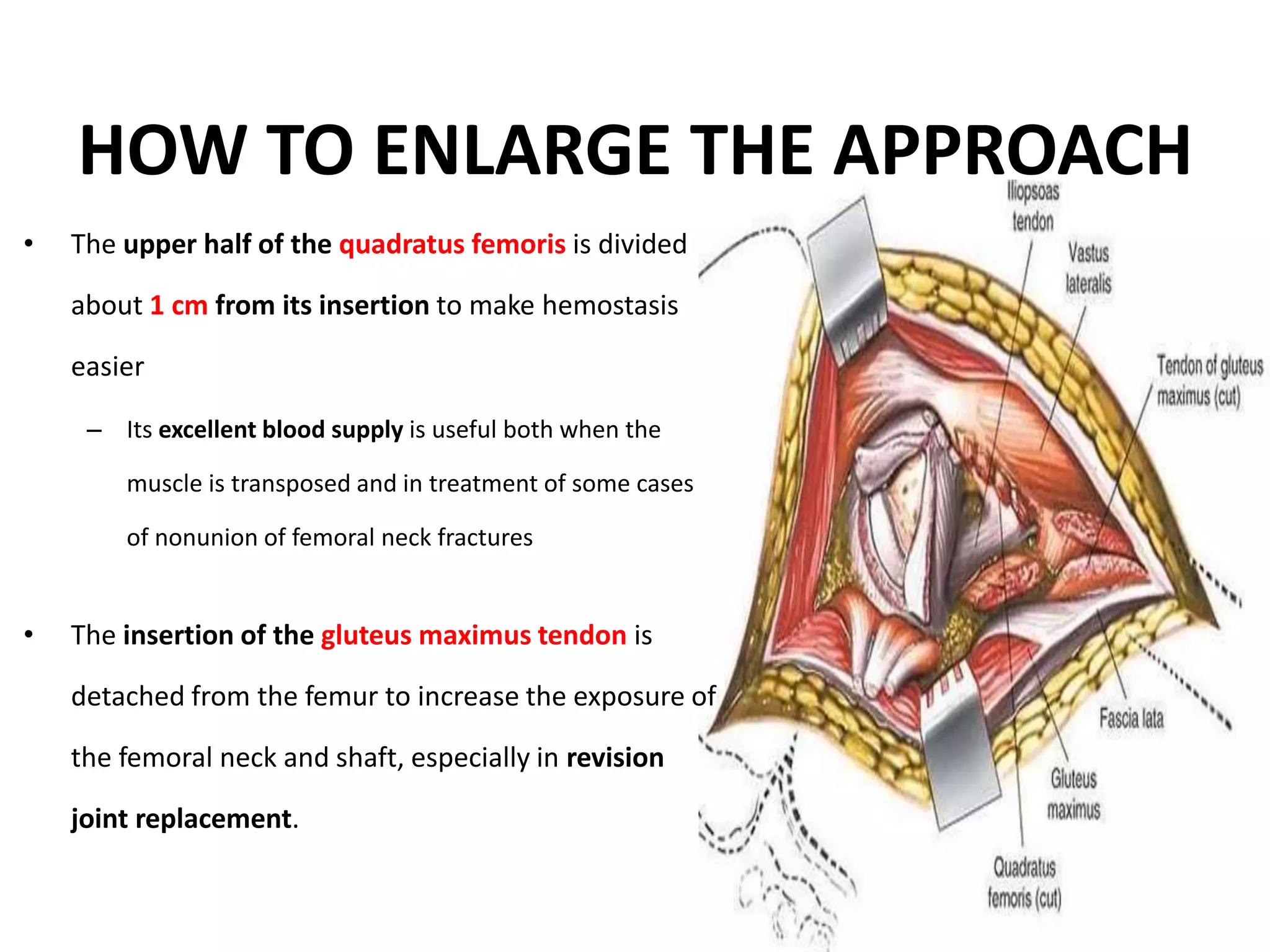 Posterior approach to the hip | PPTX