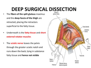 Posterior approach to the hip | PPTX