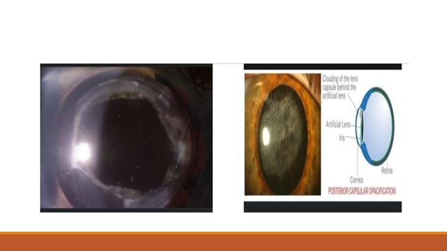 Posterior Capsular Opacification.pptx