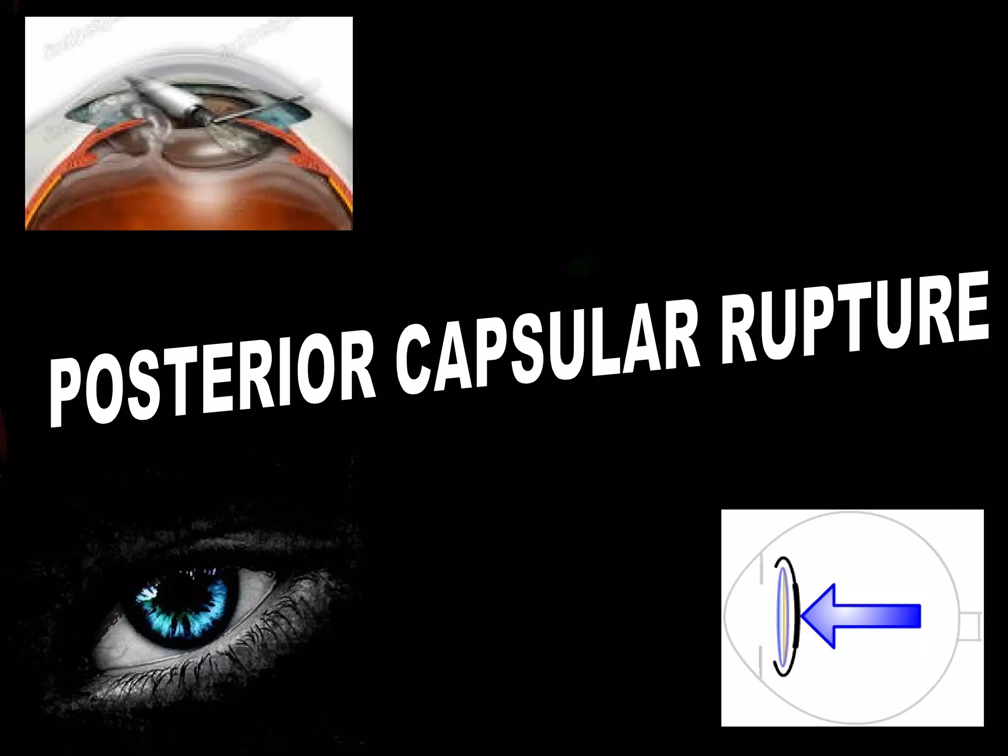 Posterior capsular rupture | PPT