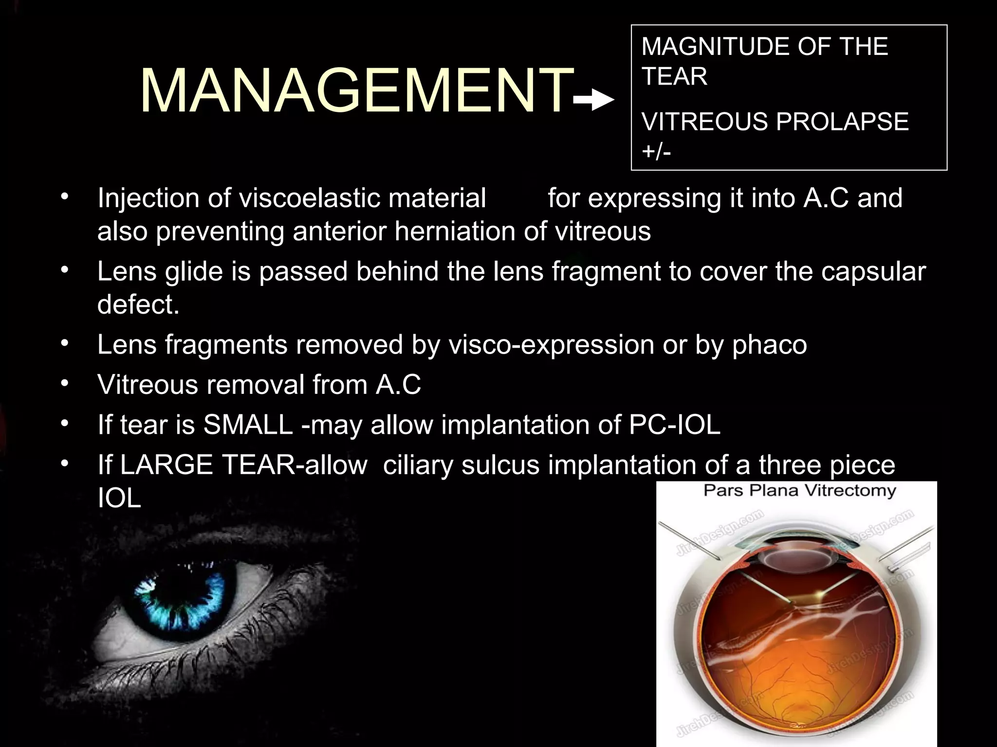 Posterior capsular rupture | PPT