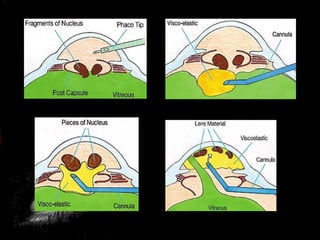 Posterior capsular rupture | PPT
