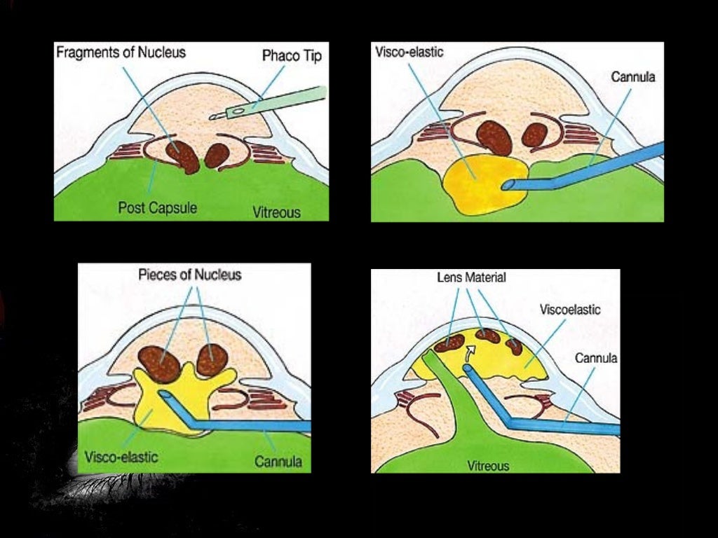 Posterior capsular rupture