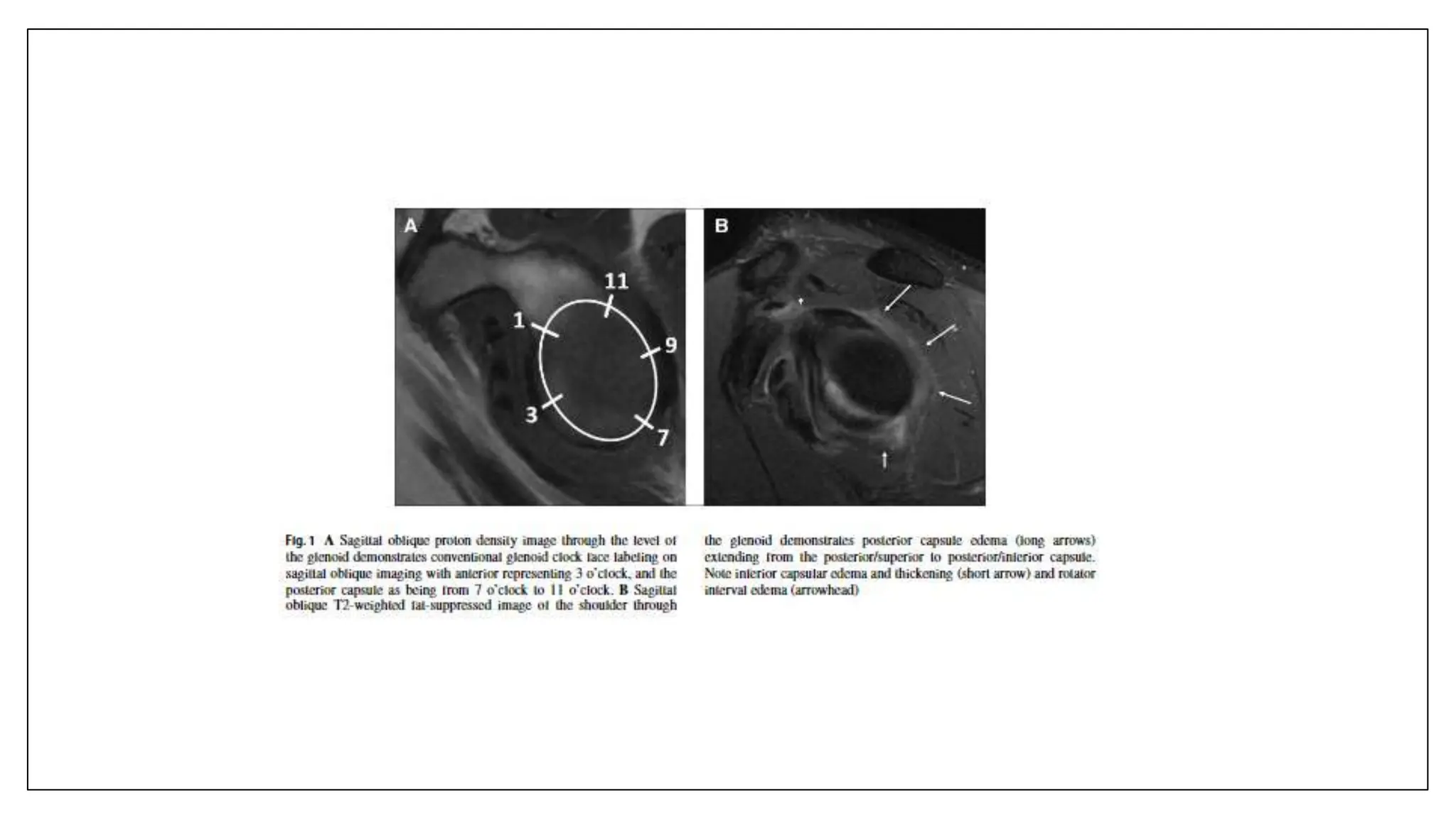 Posterior capsule edema in adhesive capsulitis.pptx
